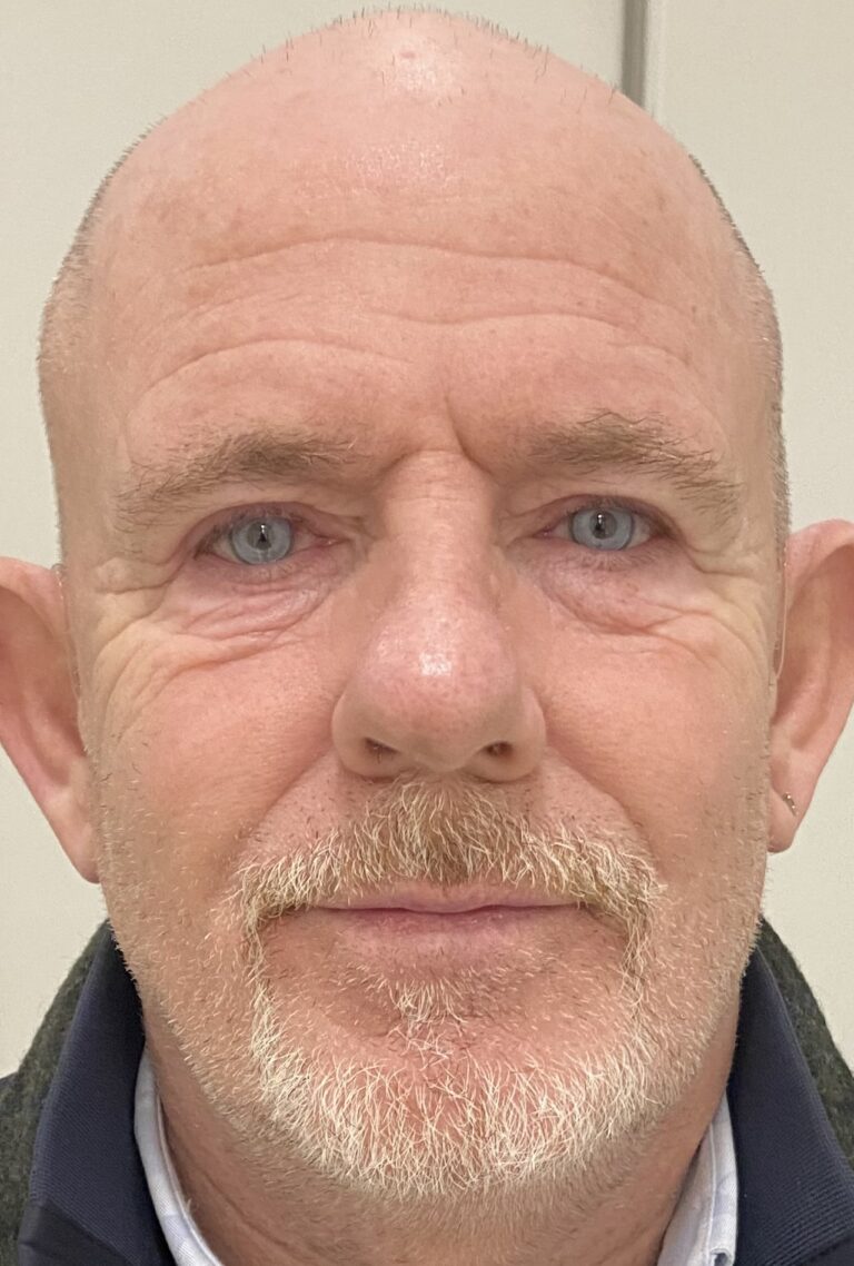 Change your eye color with Neoris - Discover our patients