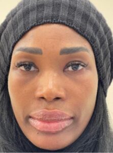 Change your eye color with Neoris - Discover our patients