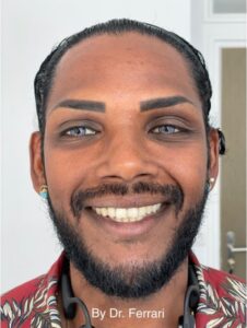 Change your eye color with Neoris - Discover our patients