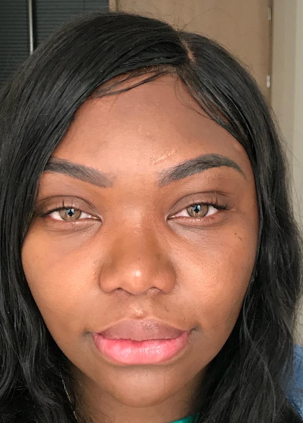 Change your eye color with Neoris - Discover our patients