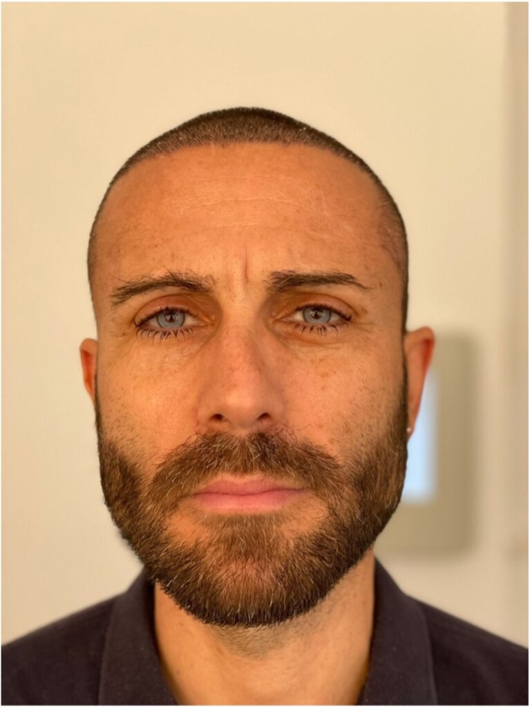 Change your eye color with Neoris - Discover our patients