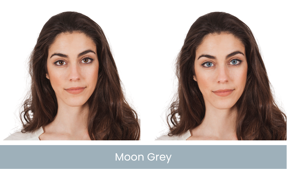 Change your eye color with Neoris - Discover our patients