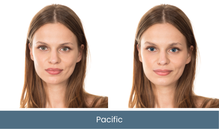 Eye color change before and after - Our keratopigmentation patients